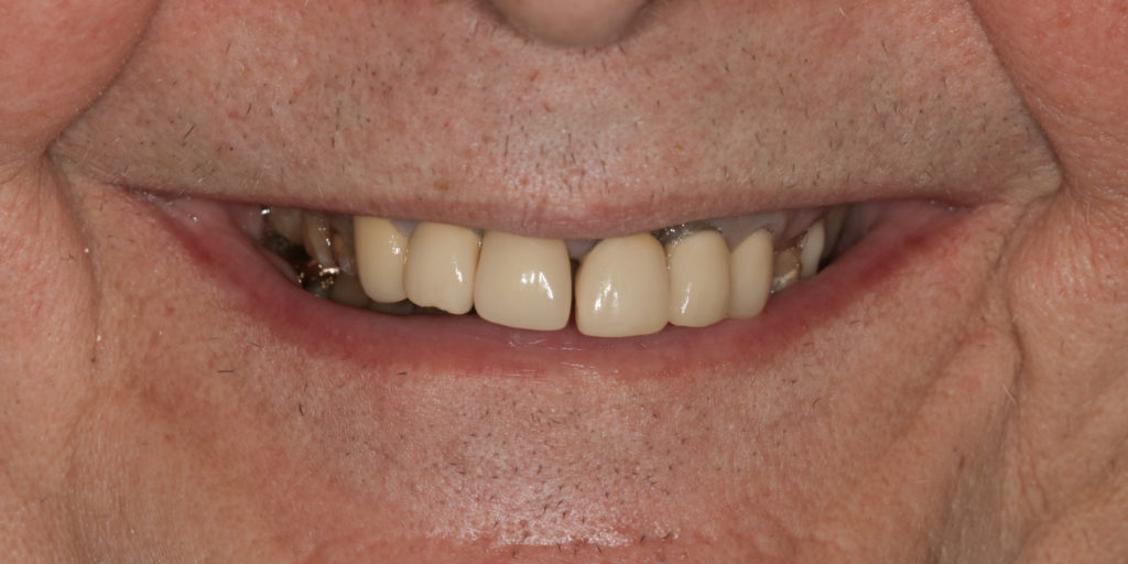 Deep Overbite- Full Mouth Rehabilitation Seattle WA, Ko Dental Implants ...